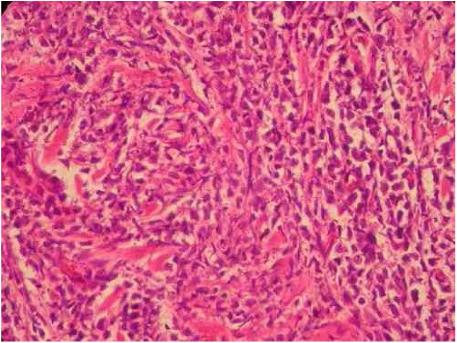 Sarcoma mieloide no couro cabeludo de paciente com leucemia mieloide ...