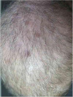 Sarcoma mieloide no couro cabeludo de paciente com leucemia mieloide ...