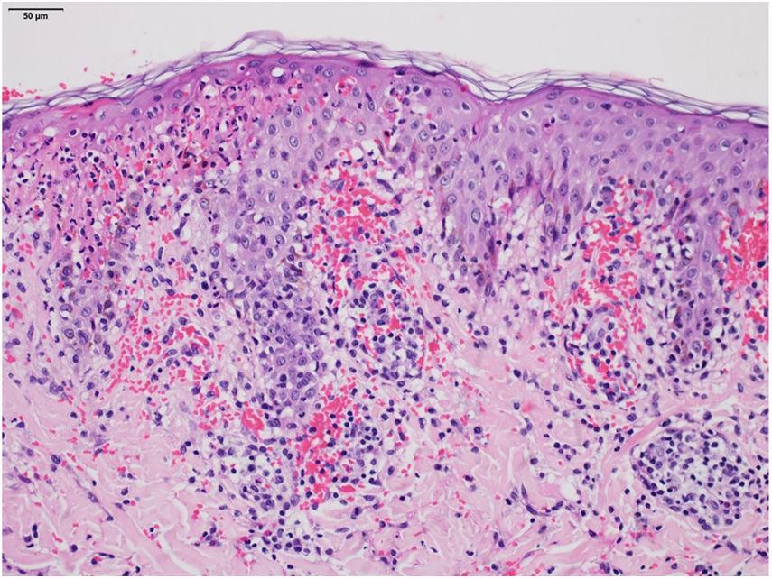 Pitiríase liquenoide e varioliforme aguda após vacinação antitetânica e ...