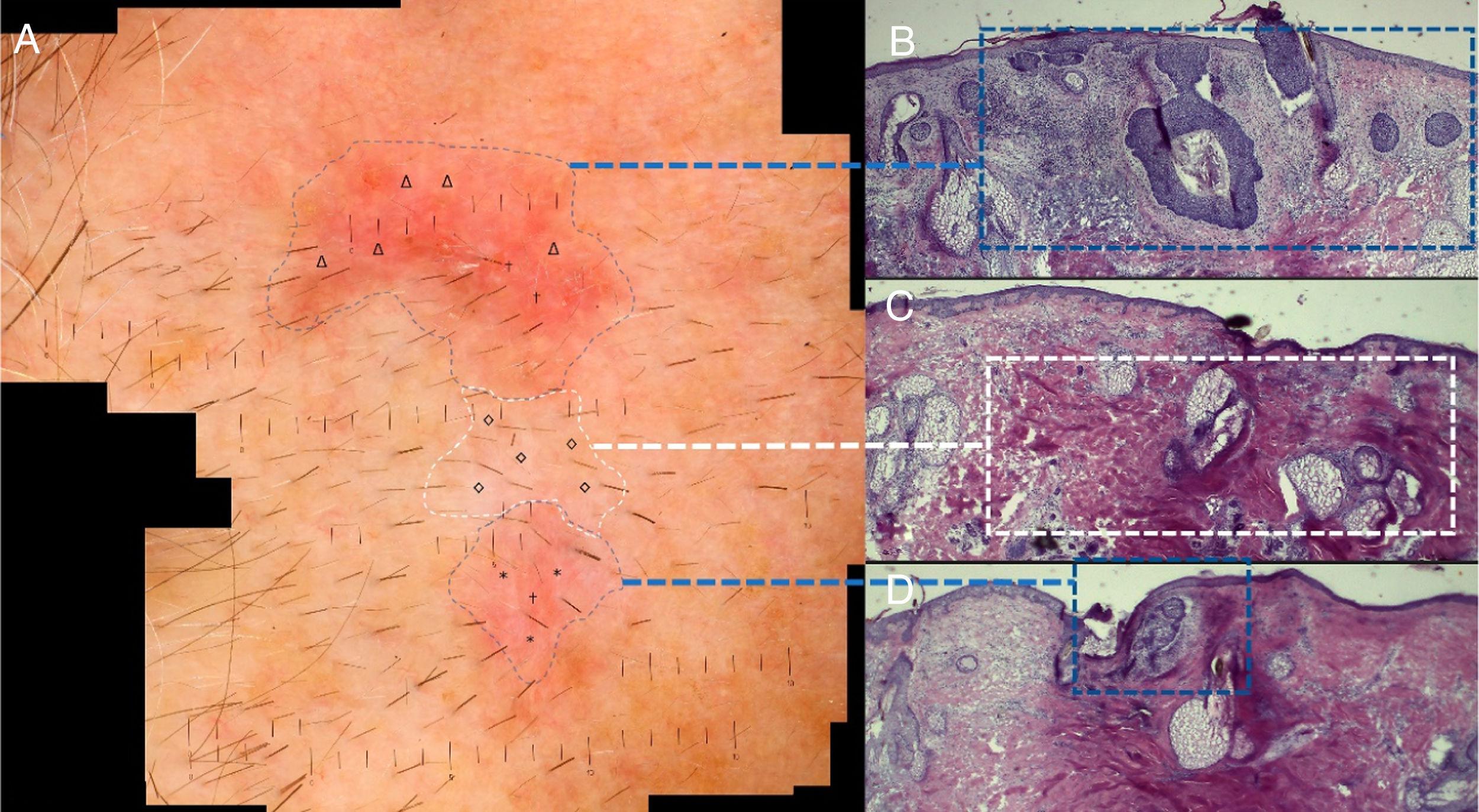 Dermatoscopia digital de área ampla aplicada ao carcinoma basocelular ...