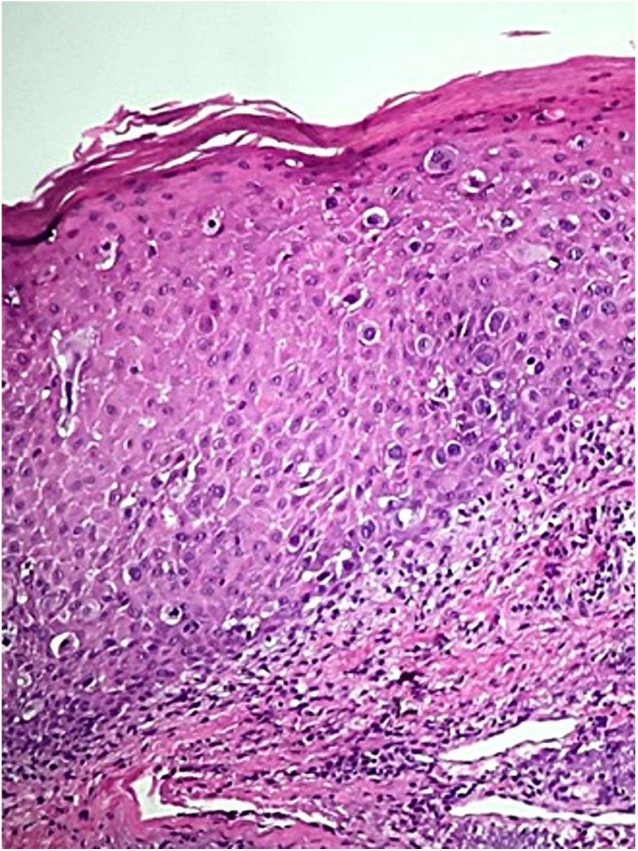 Caso para diagnóstico. Úlcera fagedênica no tórax | Anais Brasileiros ...