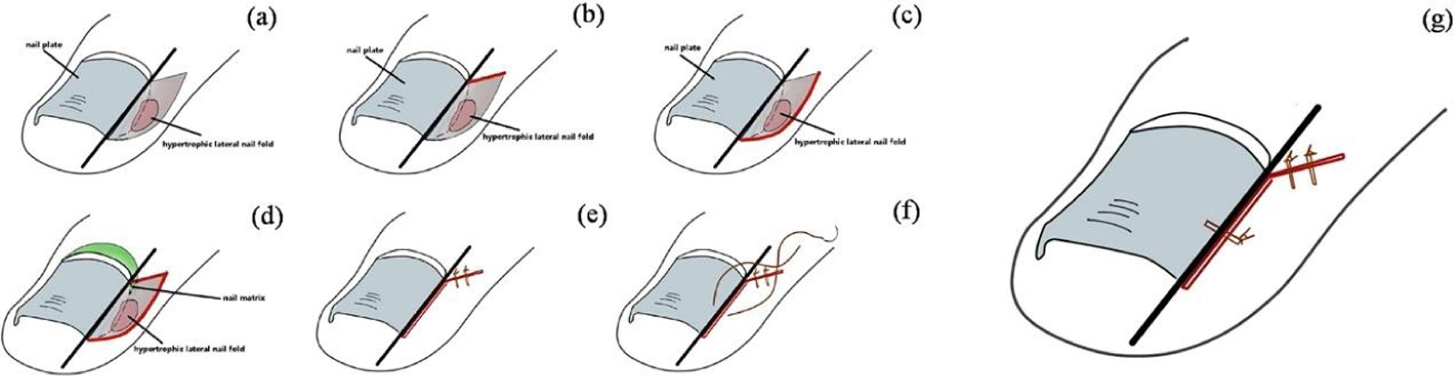Seis etapas para padronizar a abordagem cirúrgica da onicocriptose ...