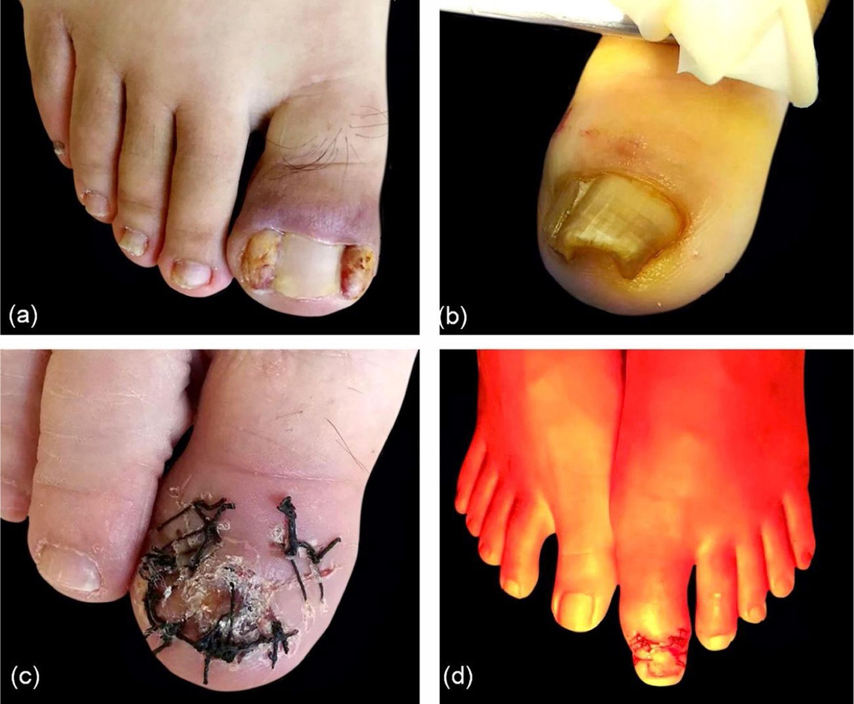 Seis etapas para padronizar a abordagem cirúrgica da onicocriptose ...