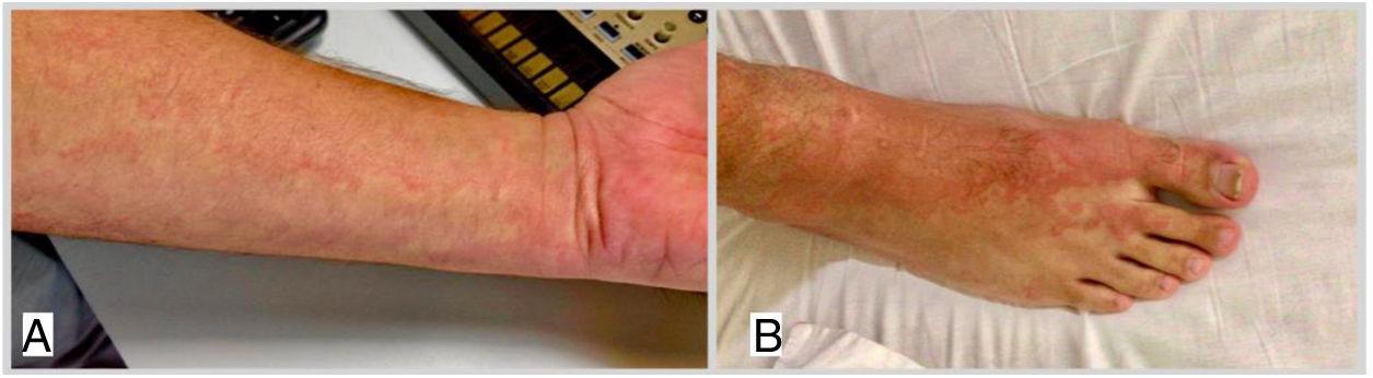 Rash cutâneo difuso em regiões tropicais: dengue ou COVID‐19? | Anais ...