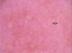 Dermatoscopia das infestações e infecções cutâneas (entomodermatoscopia ...