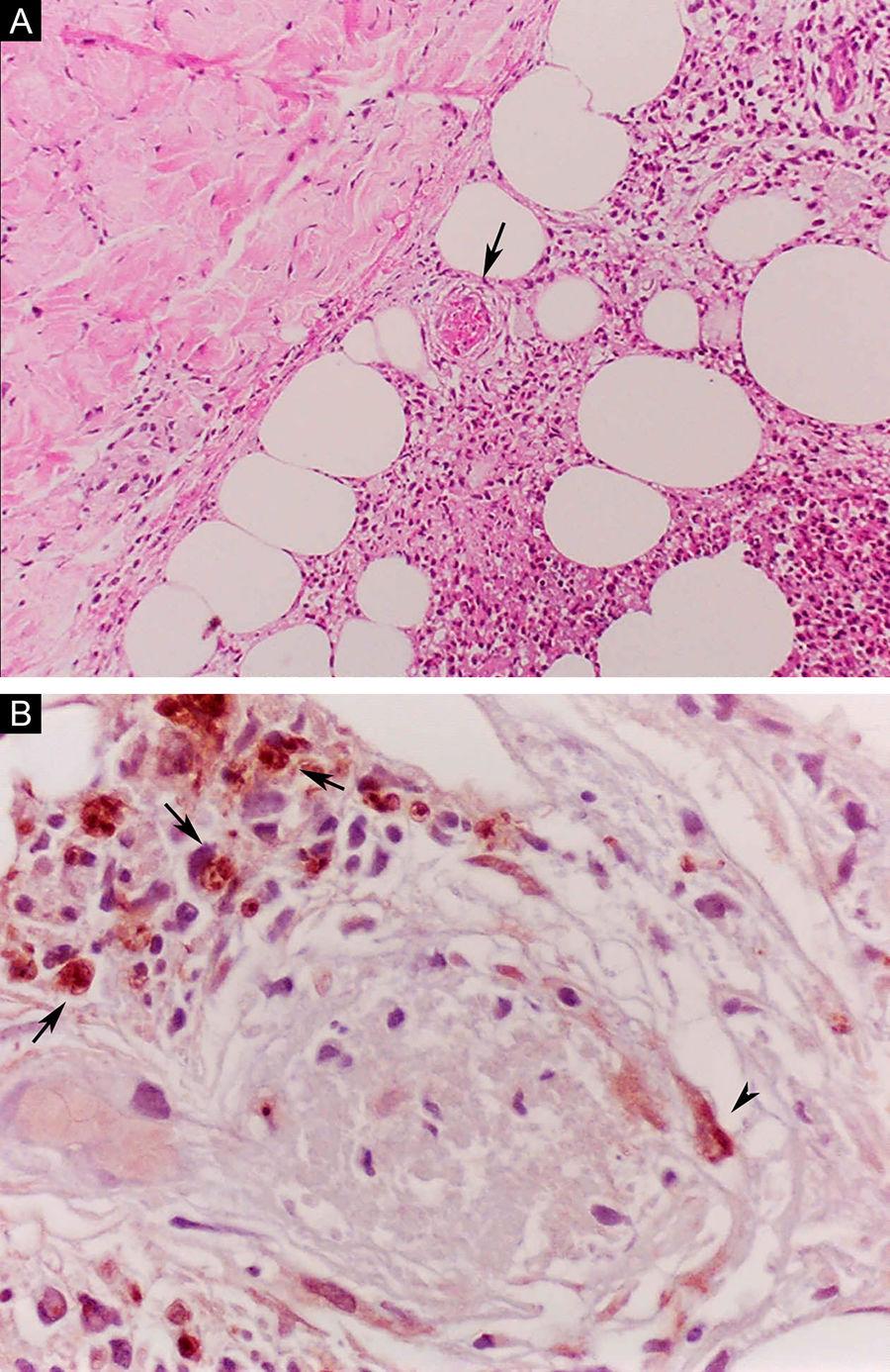 Hanseníase: características clínicas e imunopatológicas | Anais ...