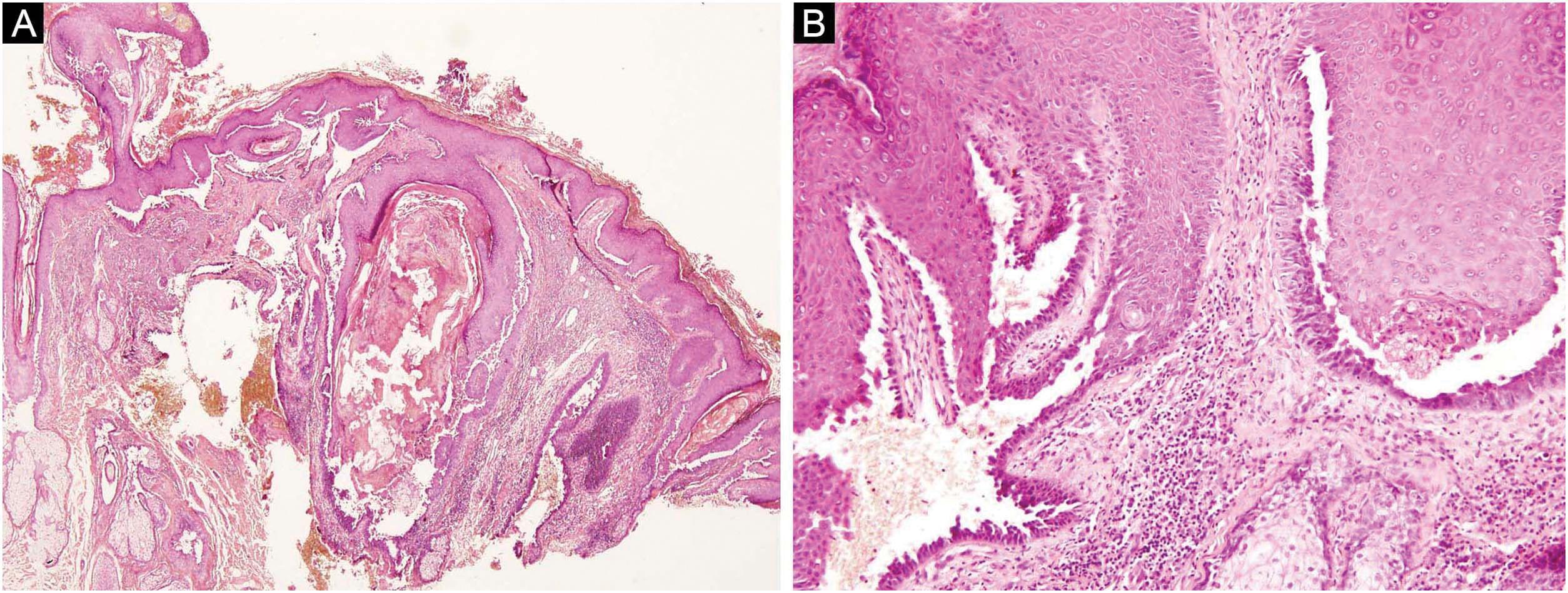 Lesões vegetantes e nodulares recalcitrantes no vértice do couro ...