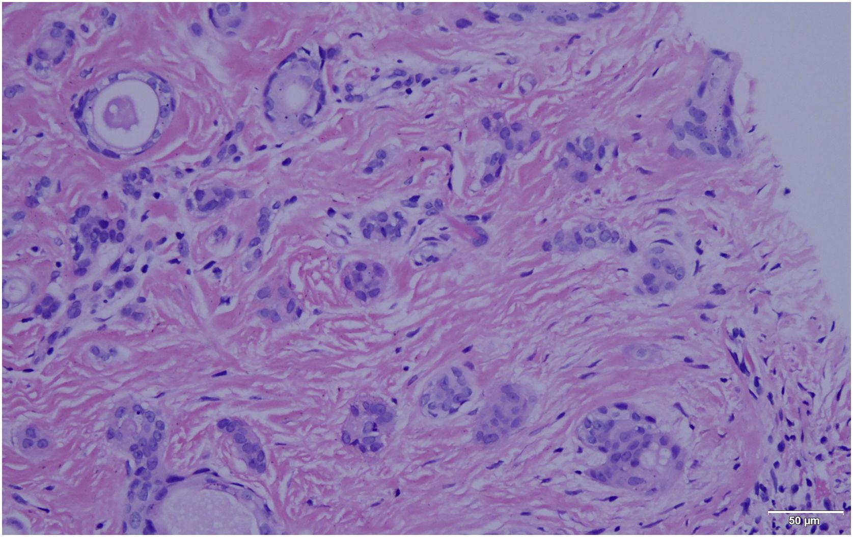 Siringoma linear unilateral no tórax e braço direito | Anais ...