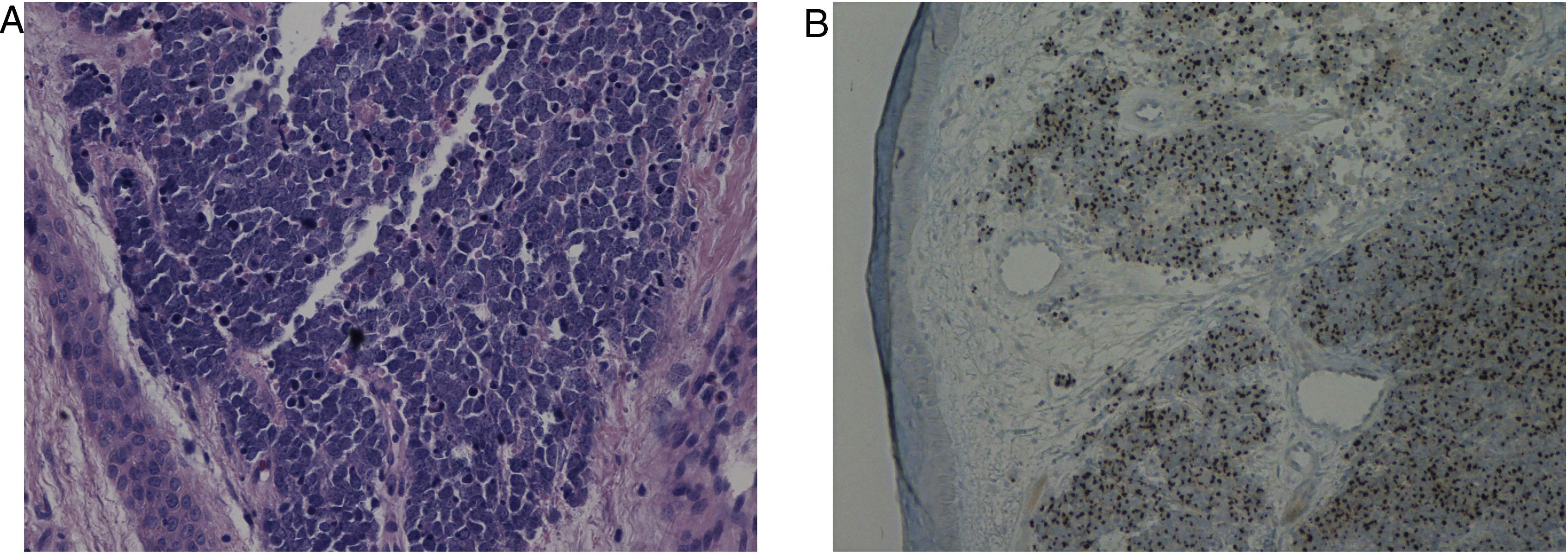 Carcinoma de células de Merkel gigante e agressivo no braço direito ...