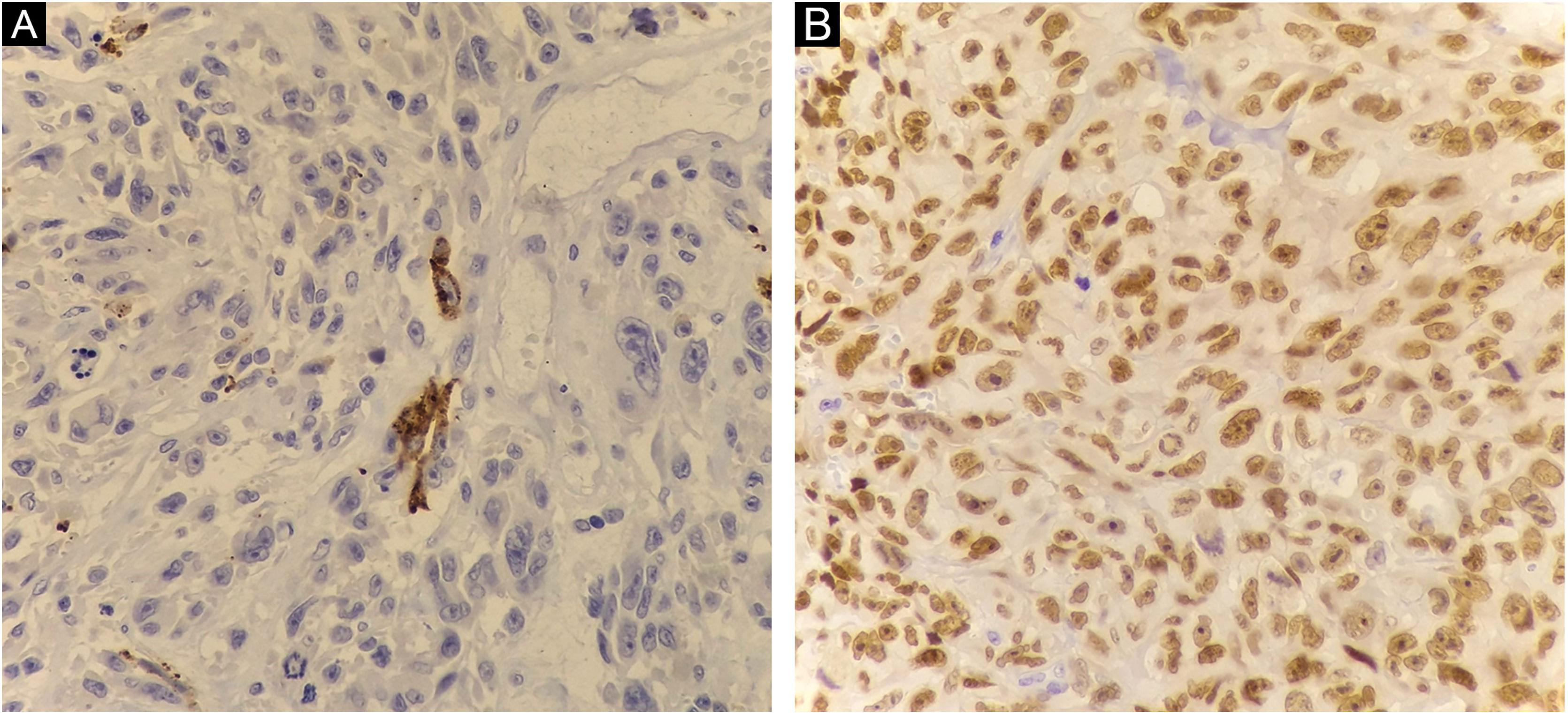 Melanoma com diferenciação osteocartilaginosa | Anais Brasileiros de ...