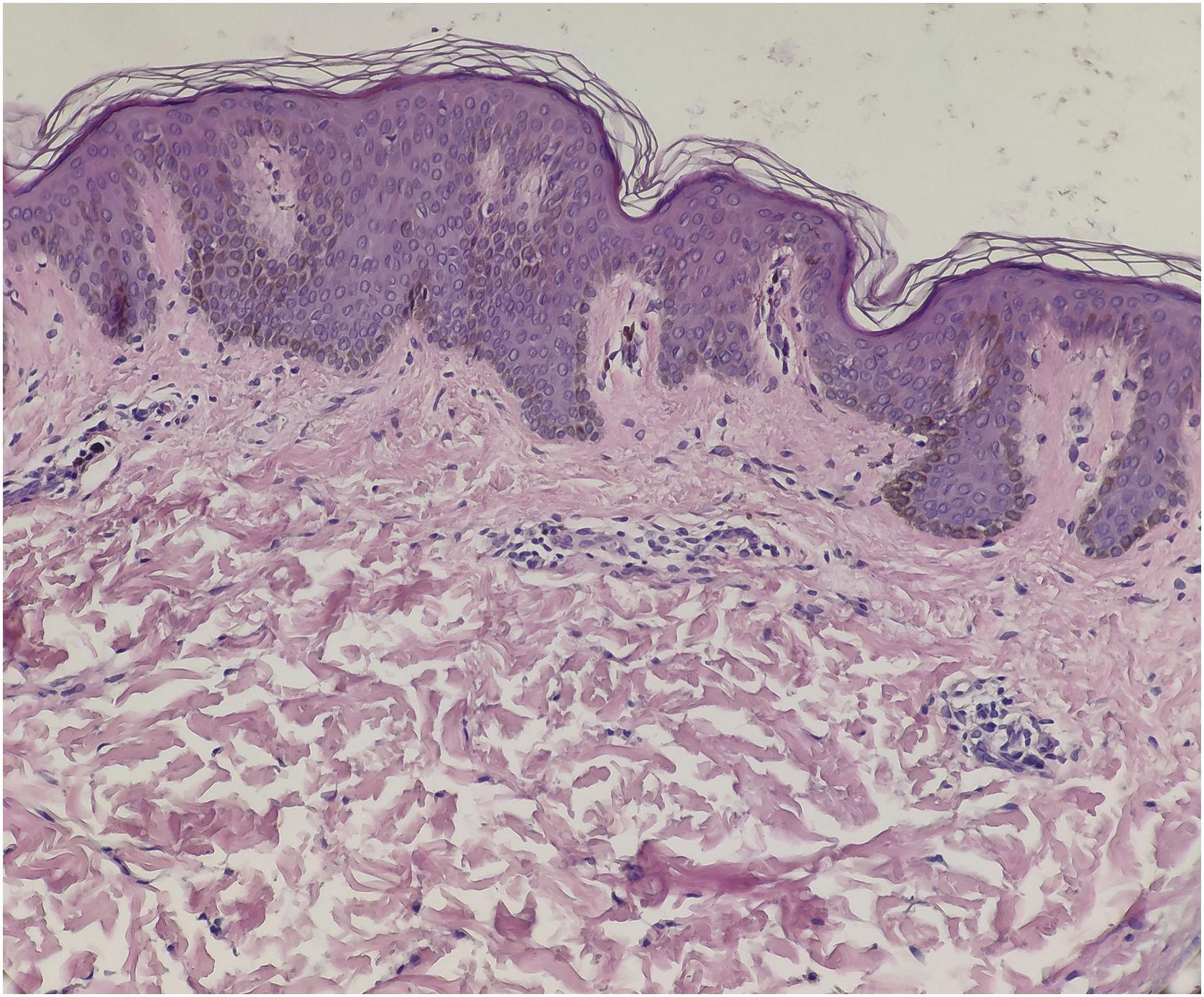 Nevo de Becker gigante bilateral | Anais Brasileiros de Dermatologia