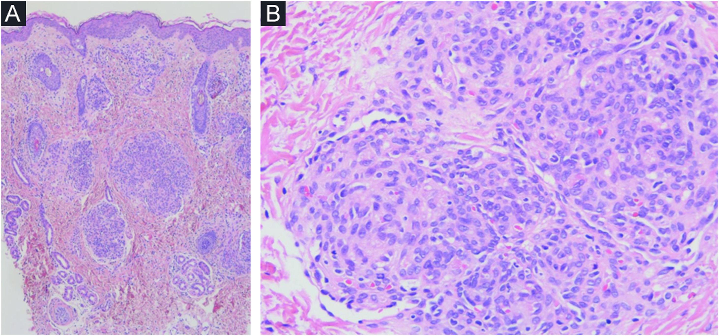 Hemangioendotelioma kaposiforme e angioma em tufos: duas entidades do ...