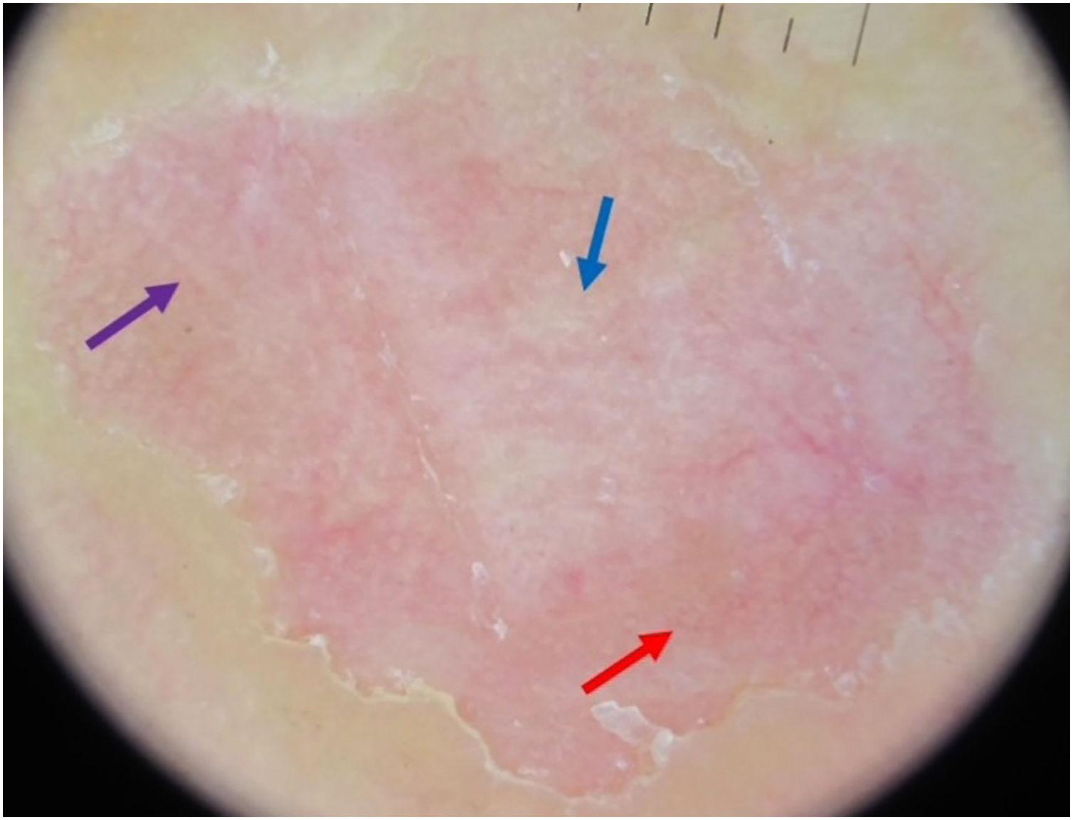 Dermatoscopia da hipoceratose circunscrita palmar | Anais Brasileiros ...
