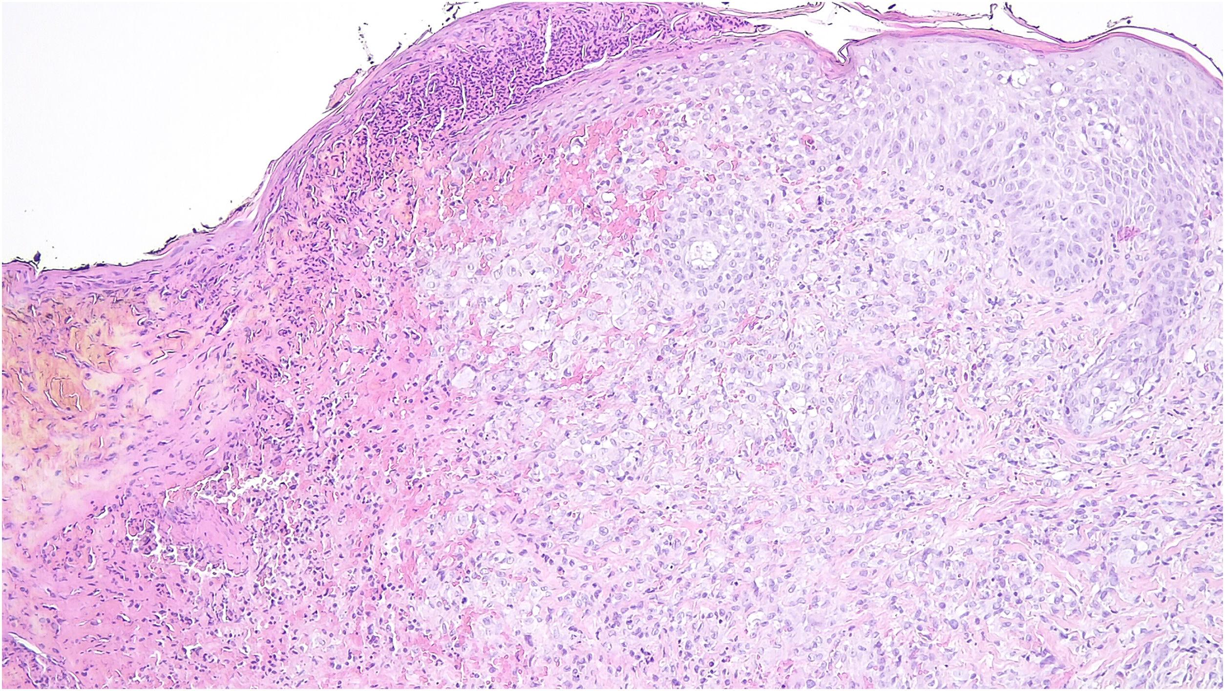 Nódulo ulcerado congênito: histiocitose de células de Langerhans ...