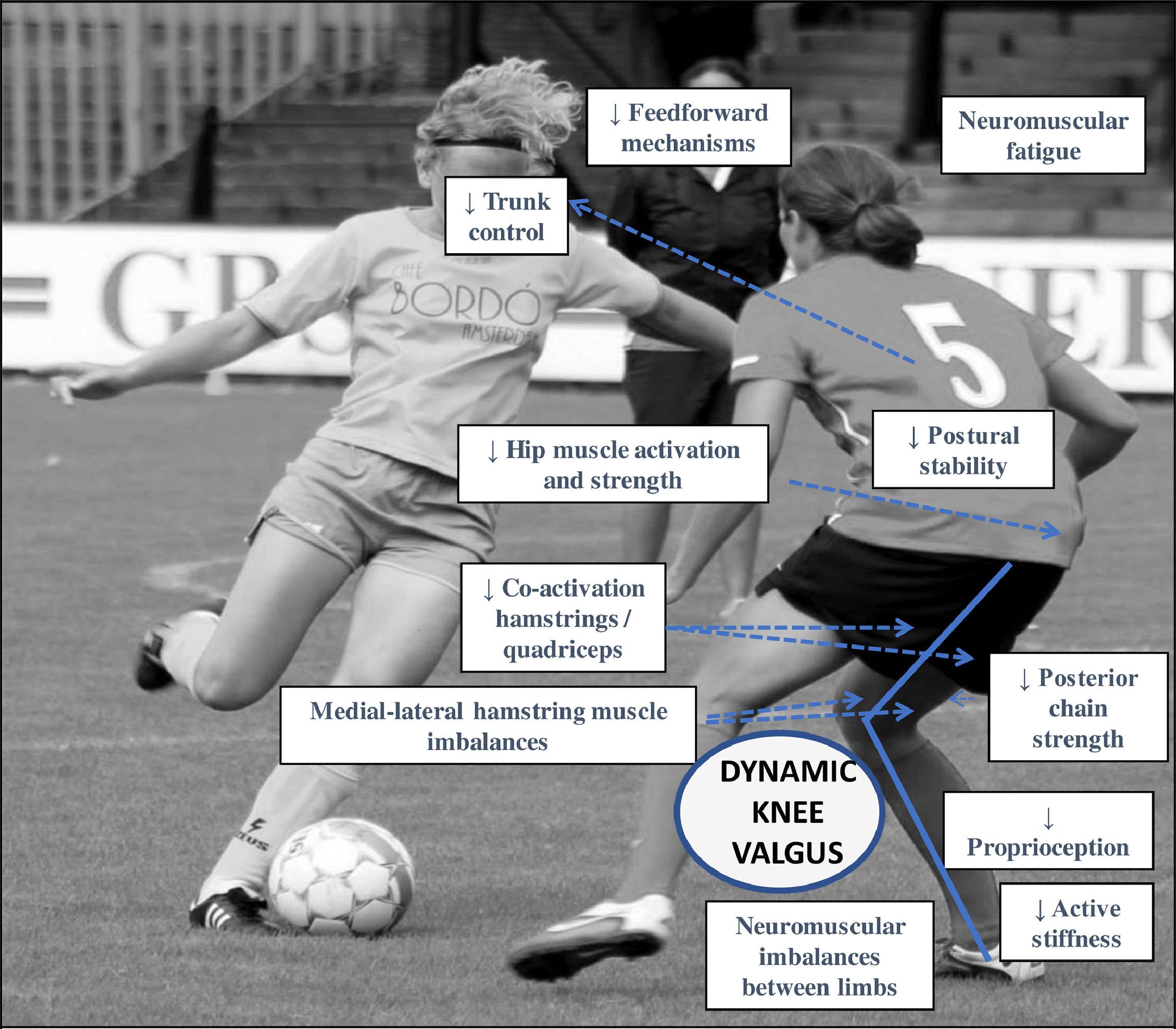 Return-to-sport following anterior cruciate ligament reconstruction in ...