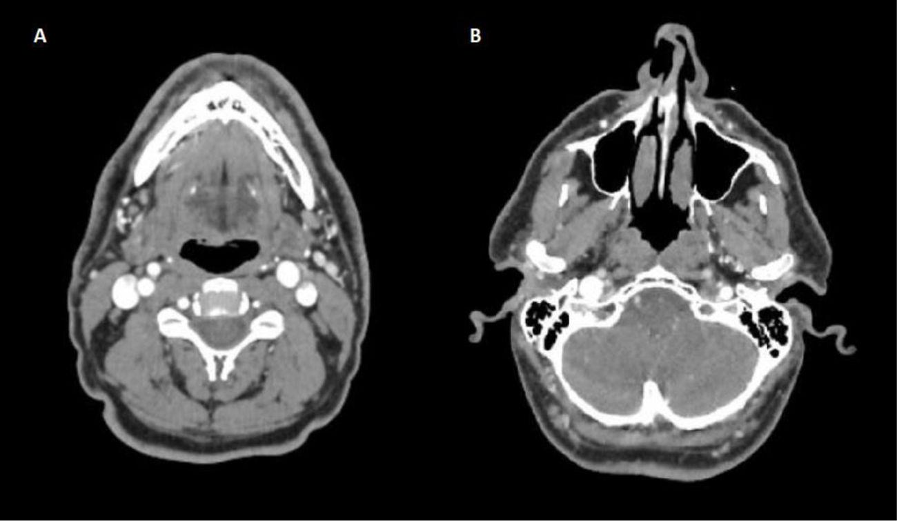 Golfo yugular prominente con asimetría del foramen yugular: una causa ...