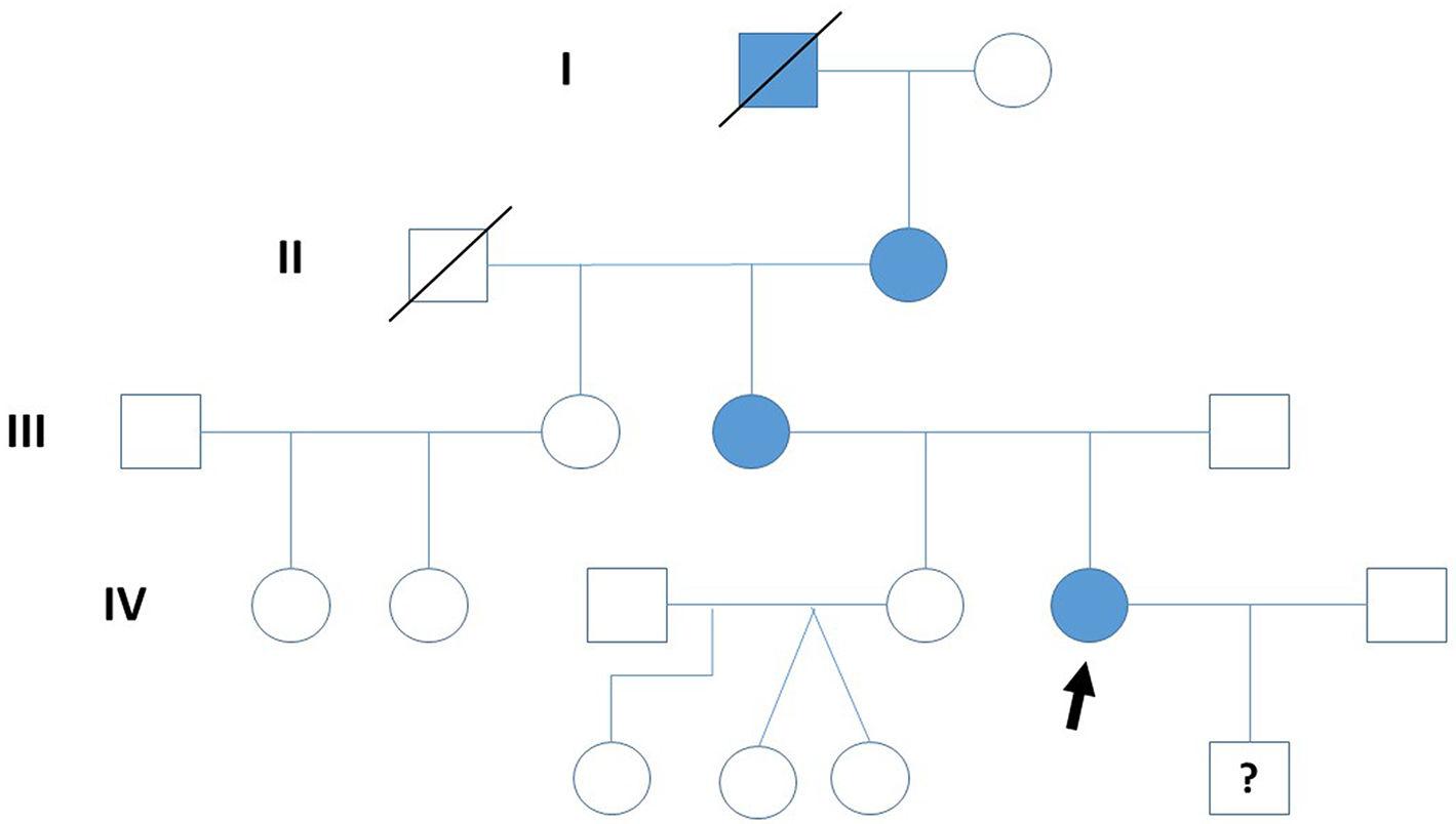 Hereditary spastic paraplegia type 4: Description of a family with a ...