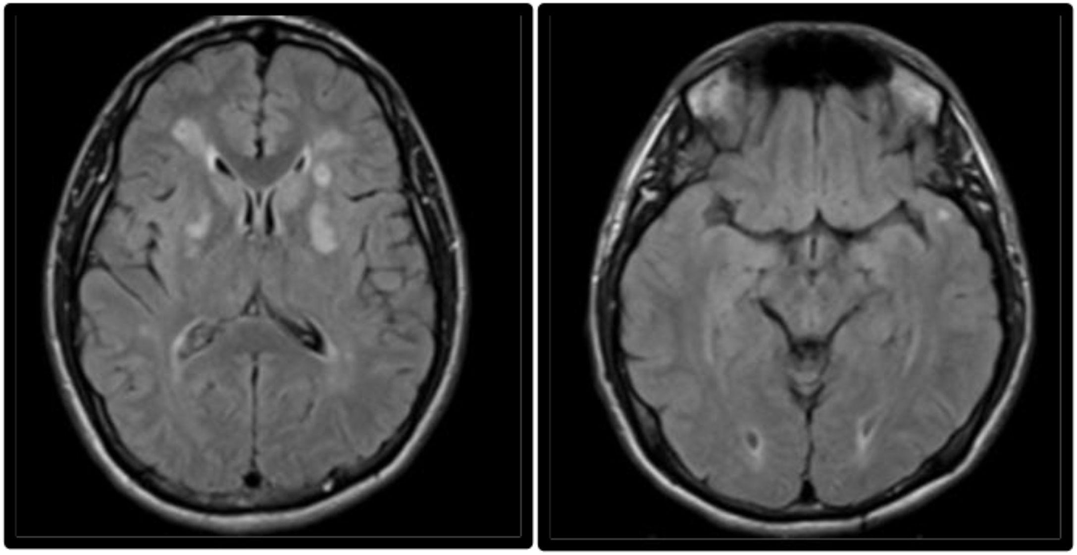 Multiple ischaemic strokes and encephalopathy in a patient with CADASIL ...