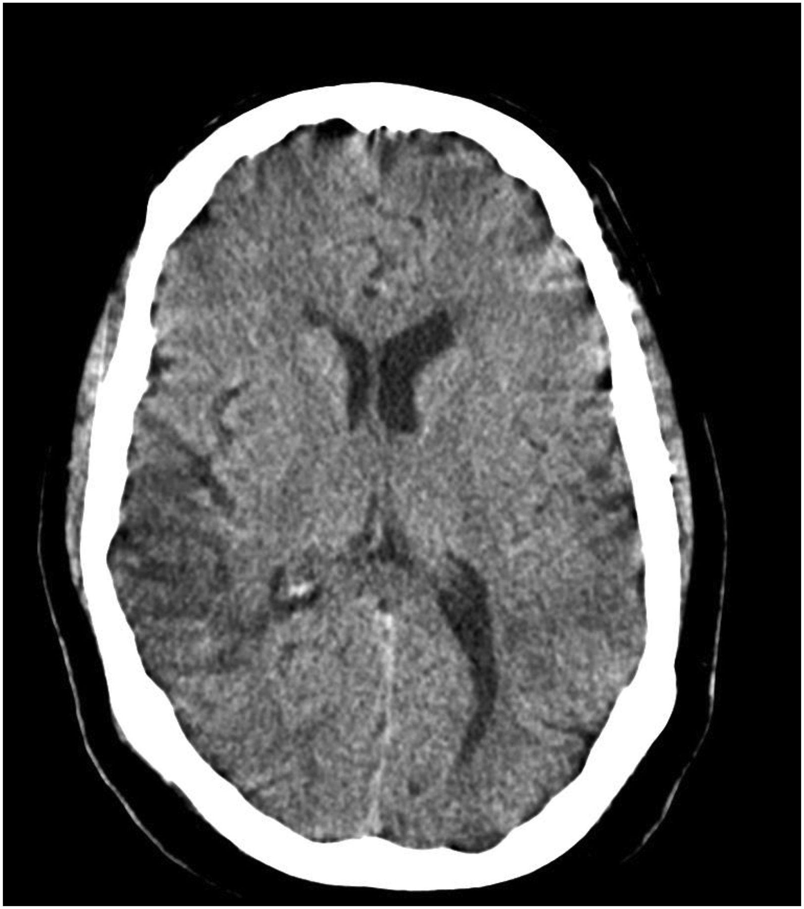 Central hearing disorders: A case report | Neurology perspectives