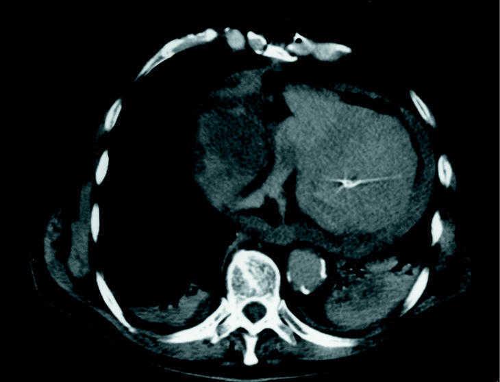 Shock secundario a compresión extrínseca de aurícula derecha por ...
