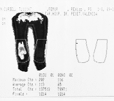 Métodos de valoración pronóstica del osteosarcoma mediante Talio-201 y ...