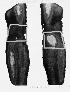 Métodos de valoración pronóstica del osteosarcoma mediante Talio-201 y ...