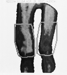 Métodos de valoración pronóstica del osteosarcoma mediante Talio-201 y ...