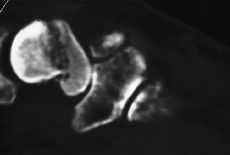 Concepto de muñeca SNAC: Scaphoid Non-union Advanced Collapse | Revista ...