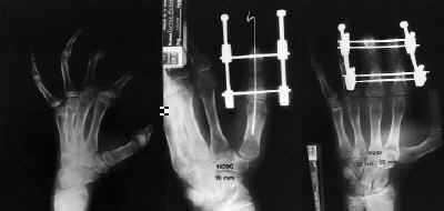 Alargamiento progresivo de los huesos de las manos mediante callotasis ...