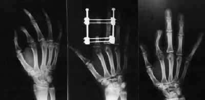 Alargamiento progresivo de los huesos de las manos mediante callotasis ...