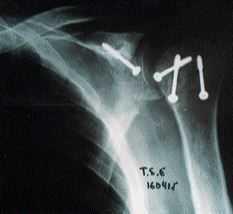 Fractura-luxación posterior de la cabeza humeral. Diagnóstico y ...