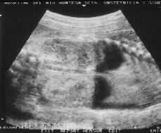 Hidrops fetalis no inmunológico | Progresos de Obstetricia y Ginecología