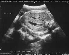 Hidrops fetalis no inmunológico | Progresos de Obstetricia y Ginecología