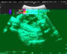 Hidrops fetalis no inmunológico | Progresos de Obstetricia y Ginecología