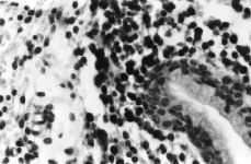 Casos clínicos Sarcoma botryoides de tracto genital femenino inferior ...