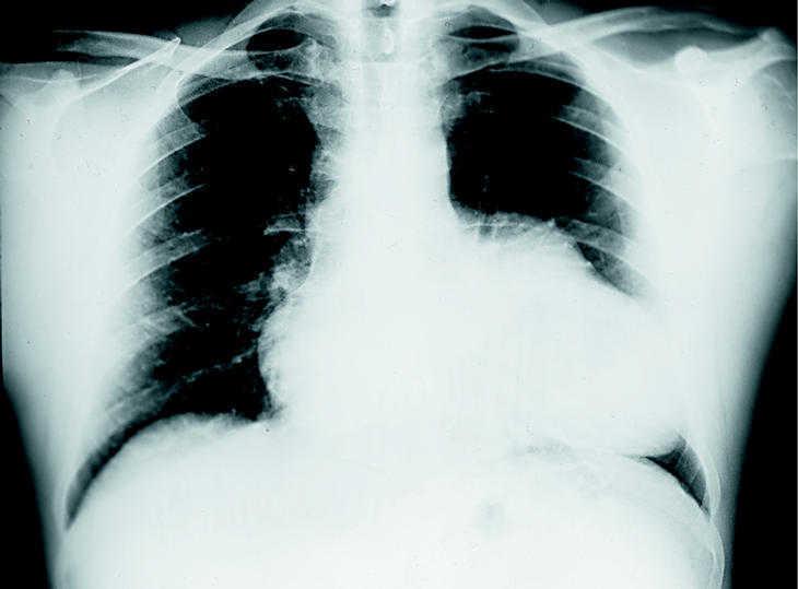 Timoma paracardíaco izquierdo | Revista Española de Cardiología