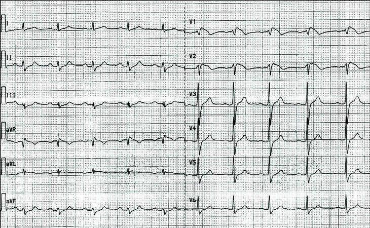 Presentación de síndrome de Brugada e intervalo QT largo en un mismo ...