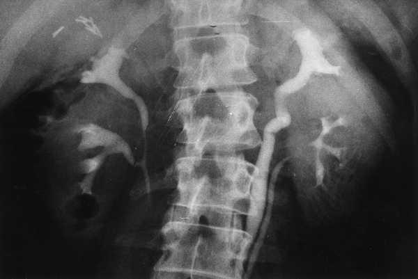 Urografía intravenosa | Medicina Integral