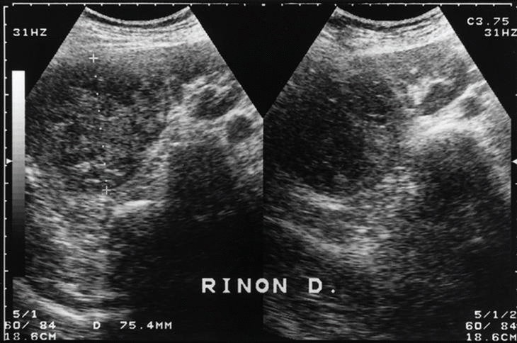 Sindrome de Stauffer o Hiperfosfatasemia como síndrome Paraneoplásico ...