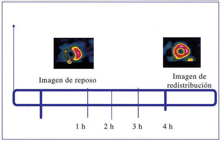 Comparación entre la eco-dobutamina y talio-201 SPECT reposo ...