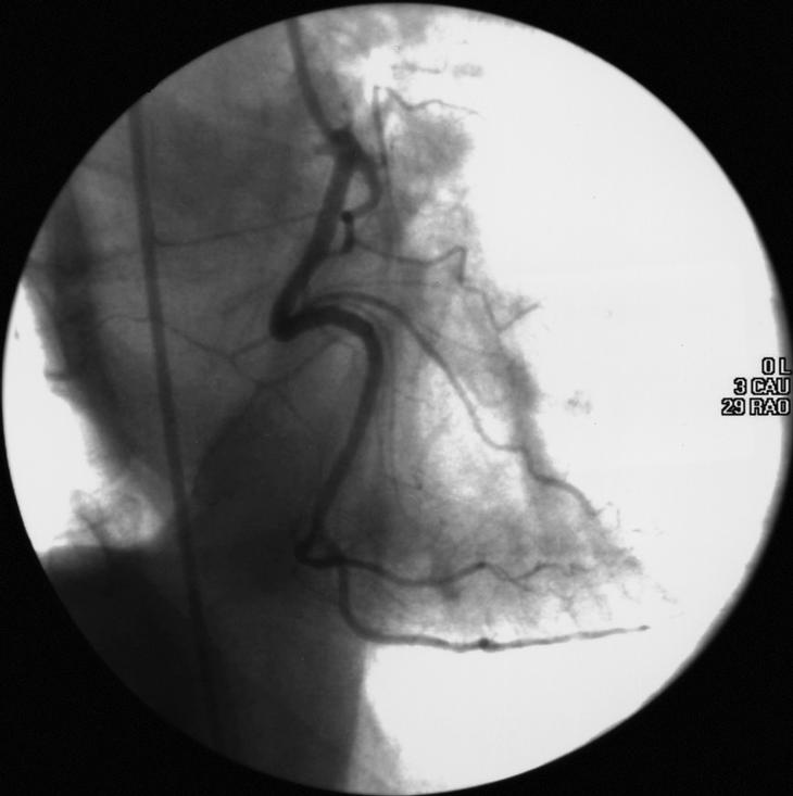Isquemia miocárdica causada por una arteria circunfleja anómala ...