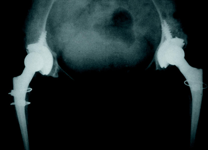 Tratamiento quirúrgico de la luxación congénita de cadera en el adulto ...