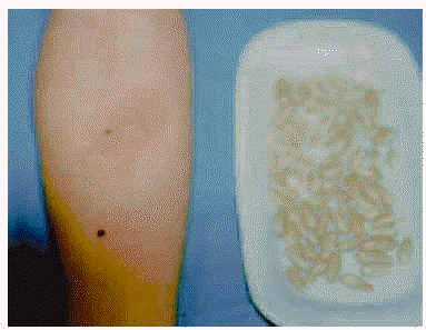 Allergy to pine nut | Allergologia et Immunopathologia