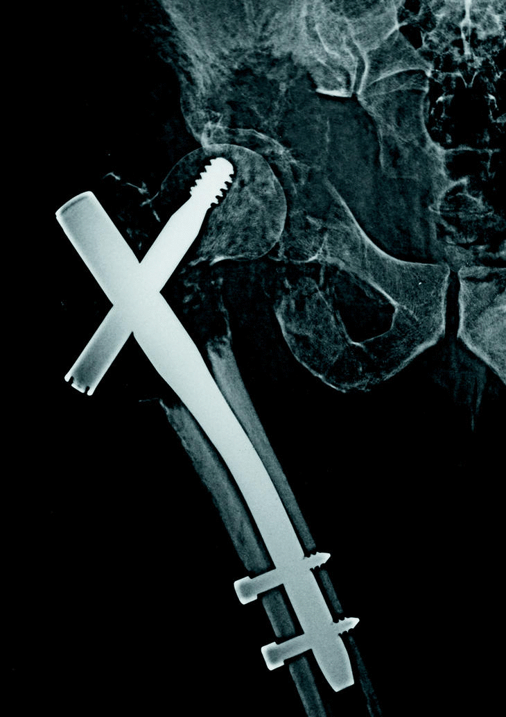 Tratamiento quirúrgico de las fracturas patológicas metastásicas del ...
