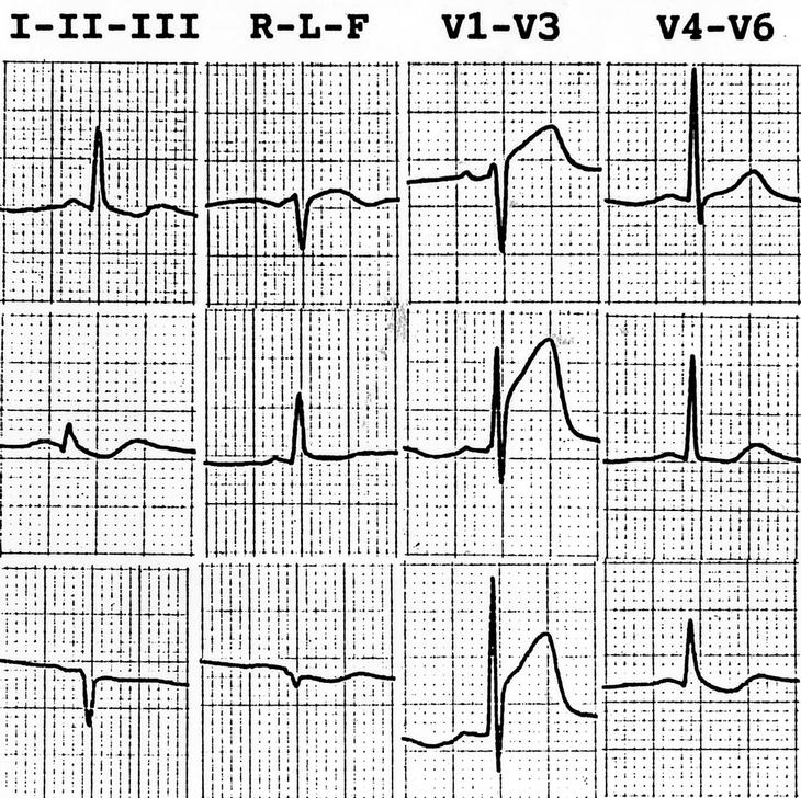 Predicción electrocardiográfica de la localización de la lesión en la ...