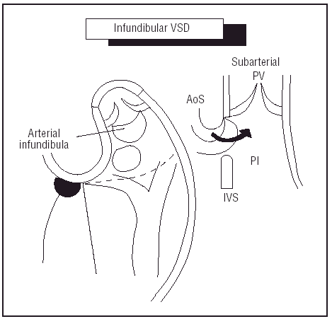 Aortic Valve Complications Associated with Subarterial Infundibular ...