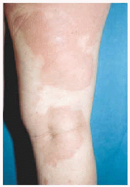 Mucinosis cutánea en placa relacionada con el embarazo | Actas Dermo ...