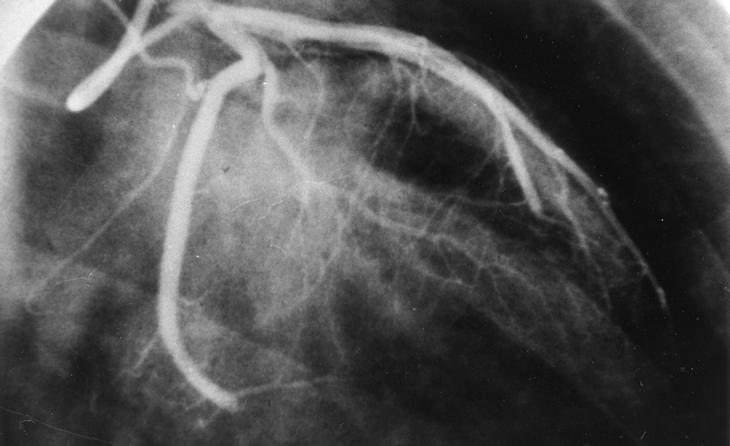 Embolismo coronario múltiple en una mujer con factores de riesgo para ...