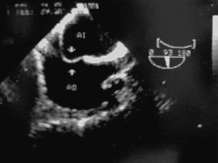 Embolismo coronario múltiple en una mujer con factores de riesgo para ...