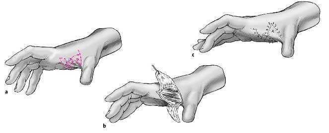 Reconstrucción del pulgar amputado mediante alargamiento del primer ...